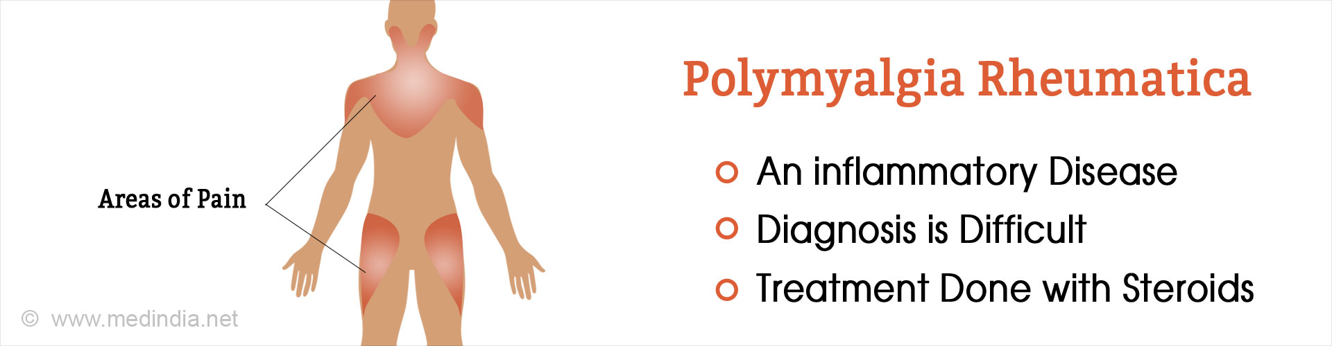 Polymyalgia Rheumatica - Causes, Symptoms, Diagnosis, Treatment & Prevention